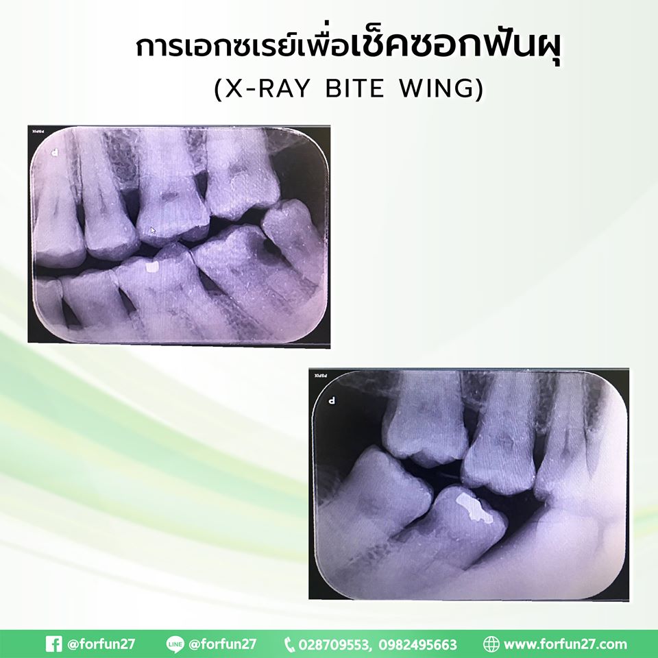 การเอ๊กซ์เรย์เช็คฟันผุ...สำคัญไฉน?? - คลีนิก ฟ.ฟัน 27 เอ๊กซ์เรย์เช็คซอก ...